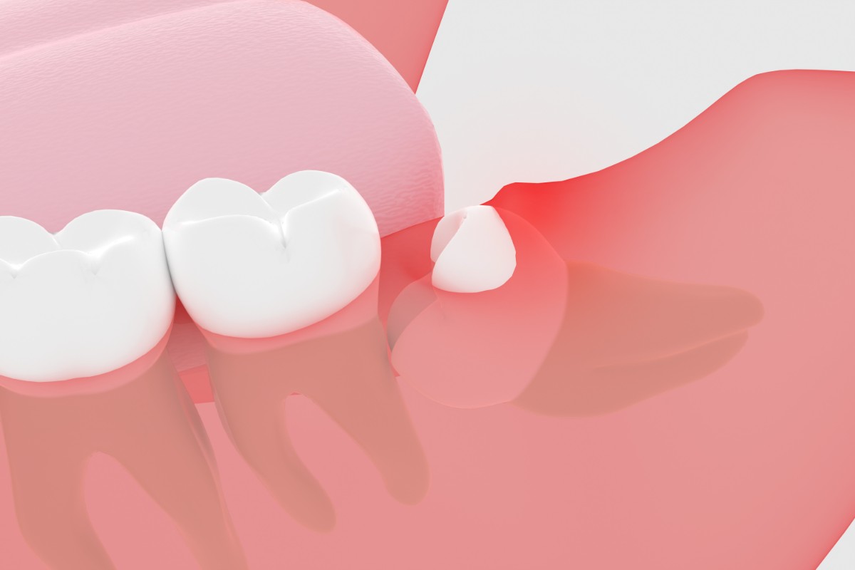 What-It-Looks-Like-When-Wisdom-Teeth-Are-Coming-In_461233080.jpg | 下北沢 ...